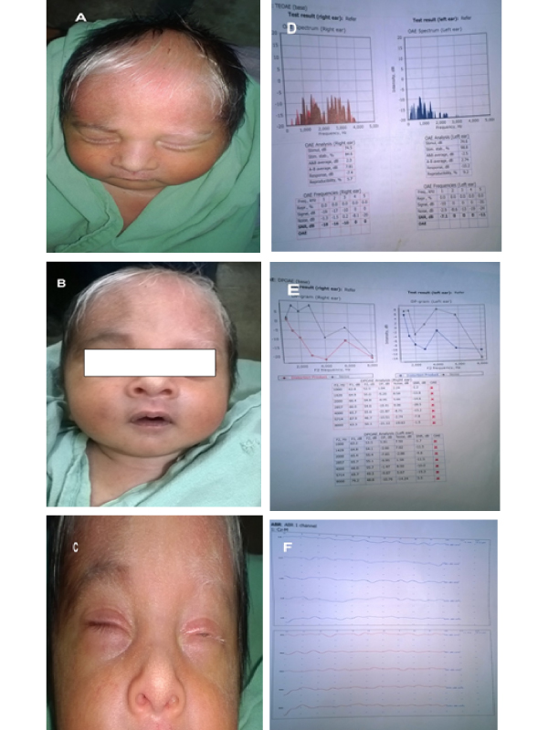 A Case Of Waardenburg Syndrome Type 1 International Journal Of
