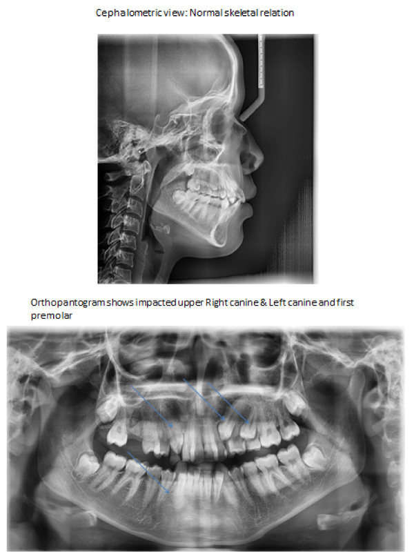 Retained Deciduous and Impacted Permanent Teeth Together with Anterior ...